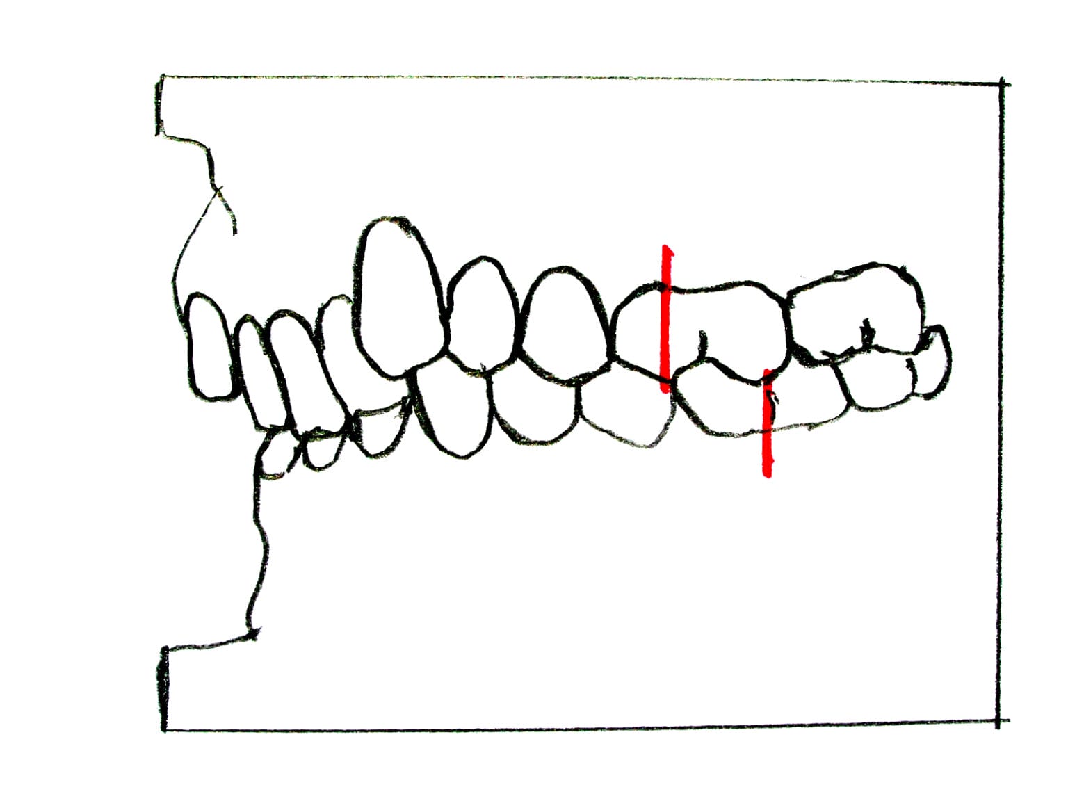 Angle's Classification of Malocclusions - ExamineDental
