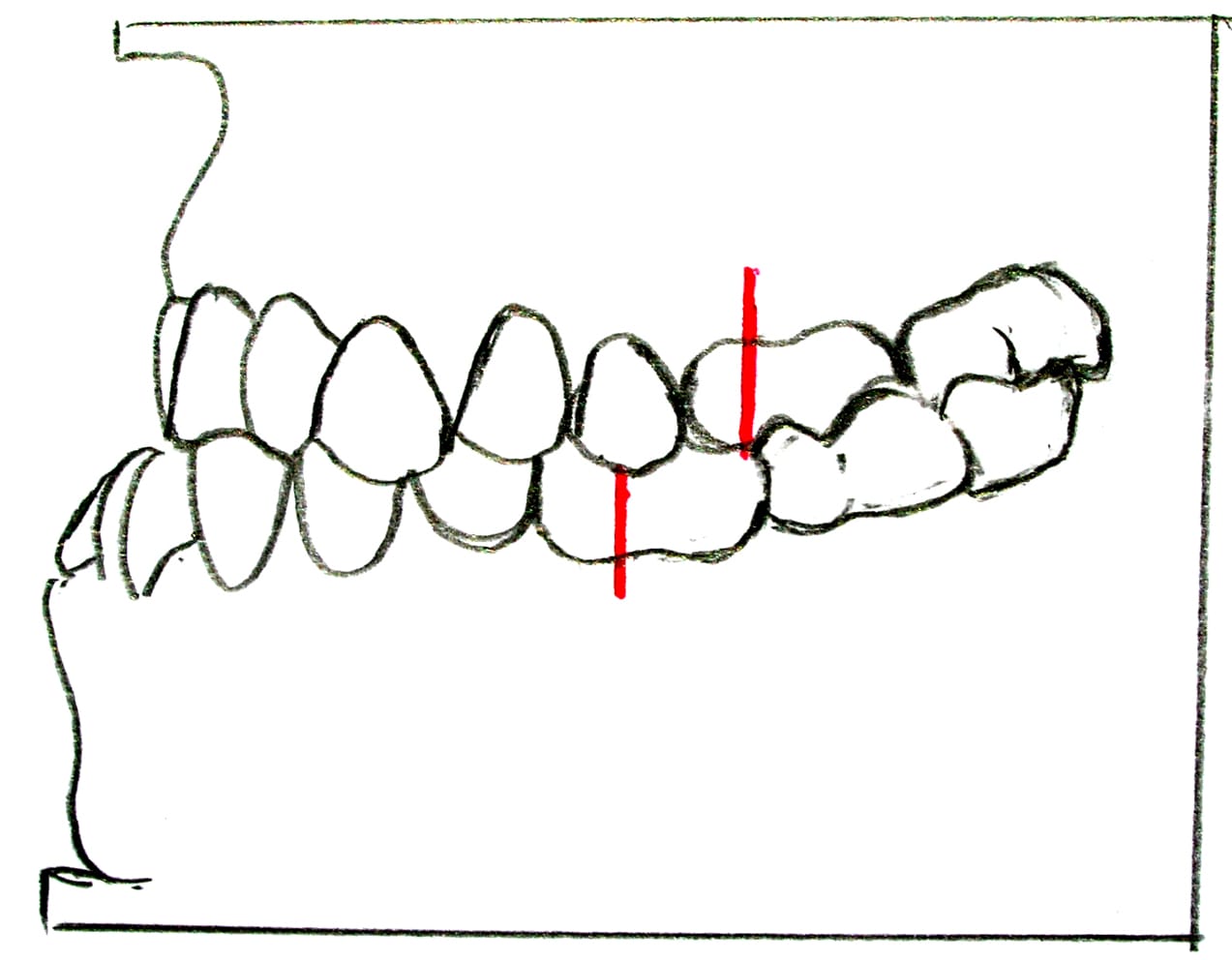 Angle's Classification of Malocclusions - ExamineDental