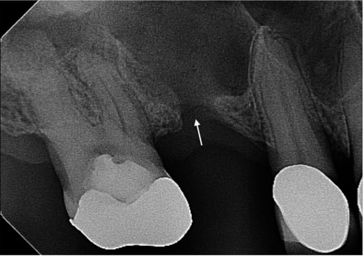 Complications of Dental Extractions - ExamineDental