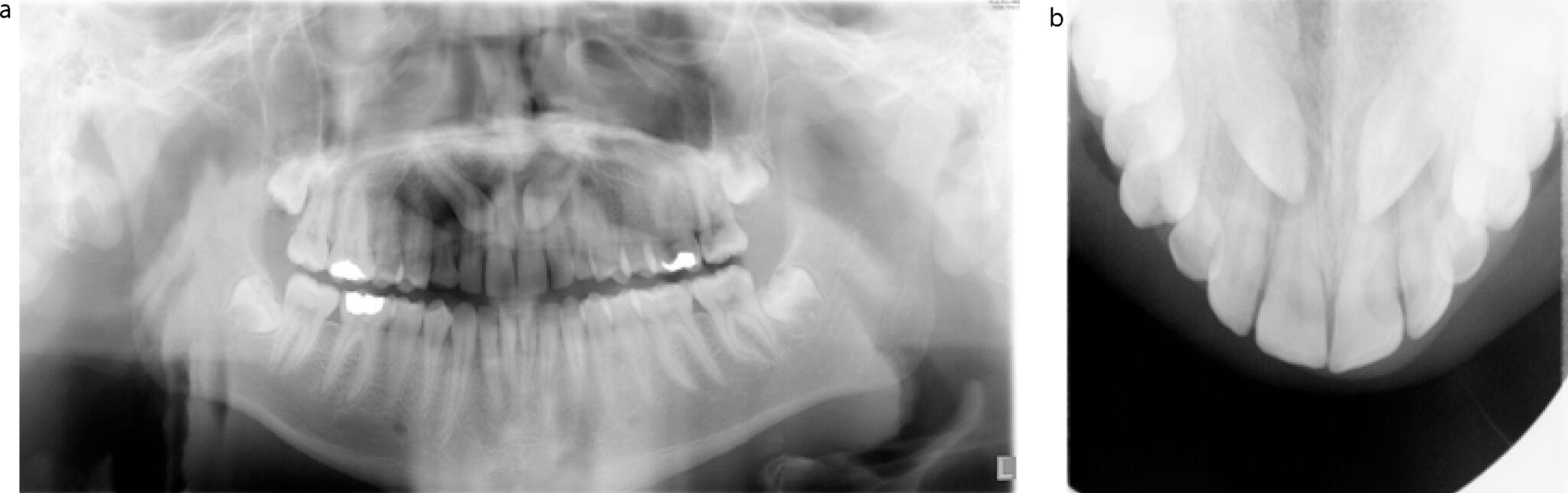 Ectopic Canines - ExamineDental