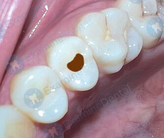 G.V. Black’s Classification of Caries - ExamineDental