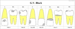 G.V. Black’s Classification of Caries - ExamineDental
